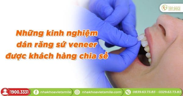 Kinh nghiệm dán răng sứ veneer tuyệt đối không thể bỏ qua