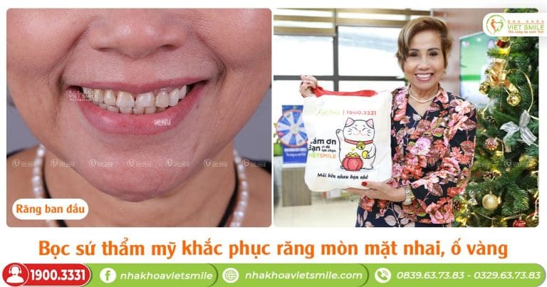 Bọc sứ khắc phục răng nhiễm kháng sinh, mòn mặt nhai - KH L.T Nhung HN14734
