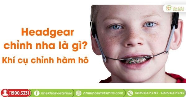 Headgear chỉnh nha là gì? Khí cụ chỉnh hàm hô