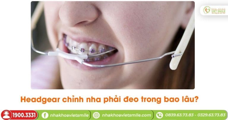 Headgear chỉnh nha là gì? Khí cụ chỉnh hàm hô